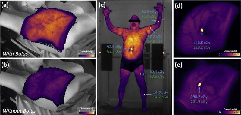 Cherenkov colour imaging shows promise in enhancing radiation therapy ...
