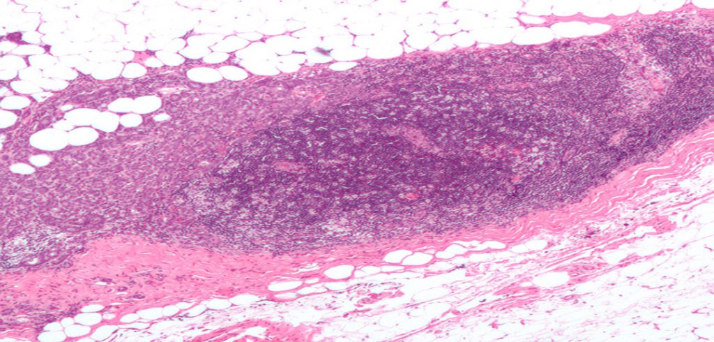 Softer tumours fuel more aggressive spread of triple-negative breast ...