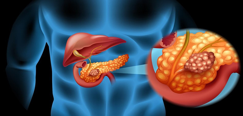 Researchers succeed at removing some types of pancreatic cancer in ...