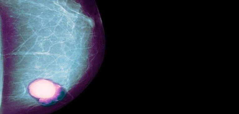 Decoding calcifications in breast cancer: Towards personalised medicine