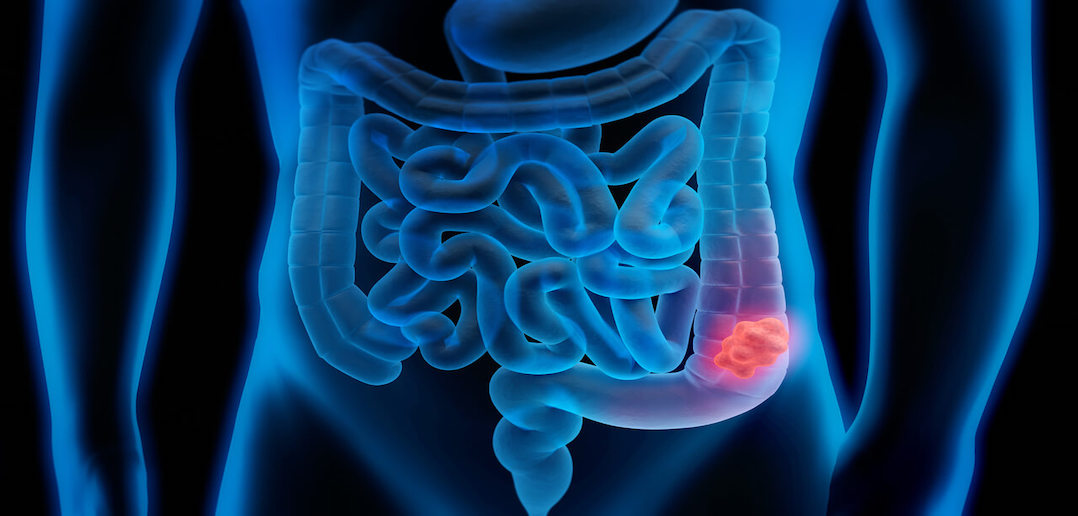 Do we need a new standard of care for colorectal cancer?