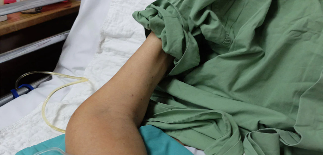 Research team develops antibodies that alleviate “cancer cachexia” in ...