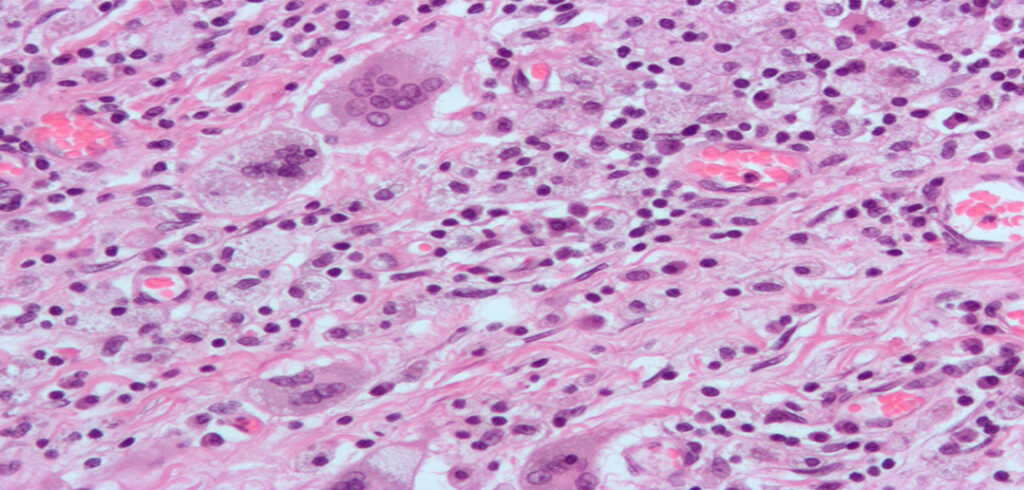 New insights on how inflammatory molecule contributes to skin and ...