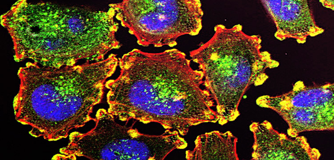 Cancer biology: Some cancer cells can lose their capability to migrate