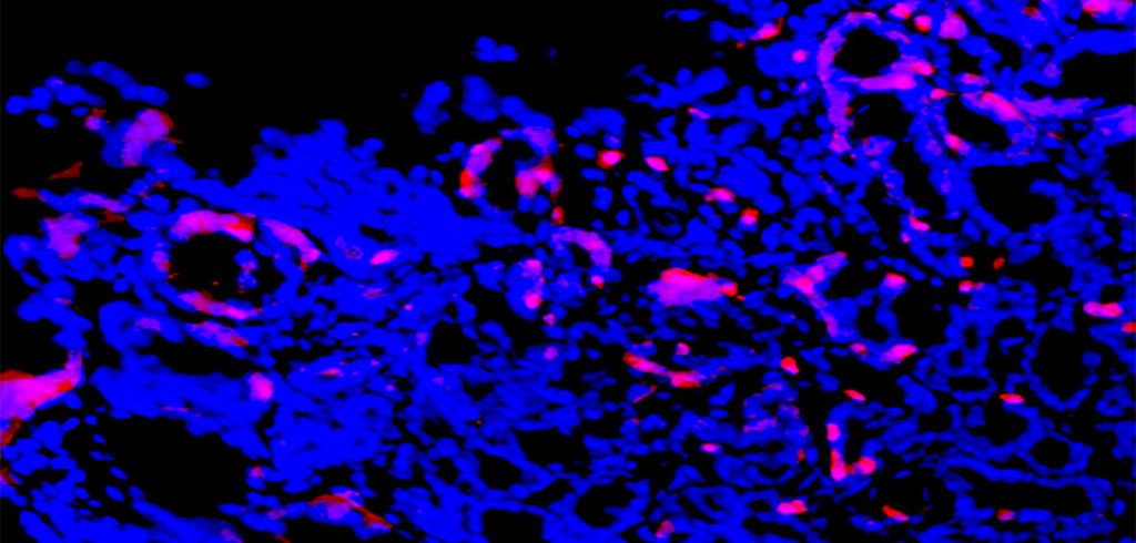 First test of anti-cancer agent PAC-1 in human clinical trials shows ...