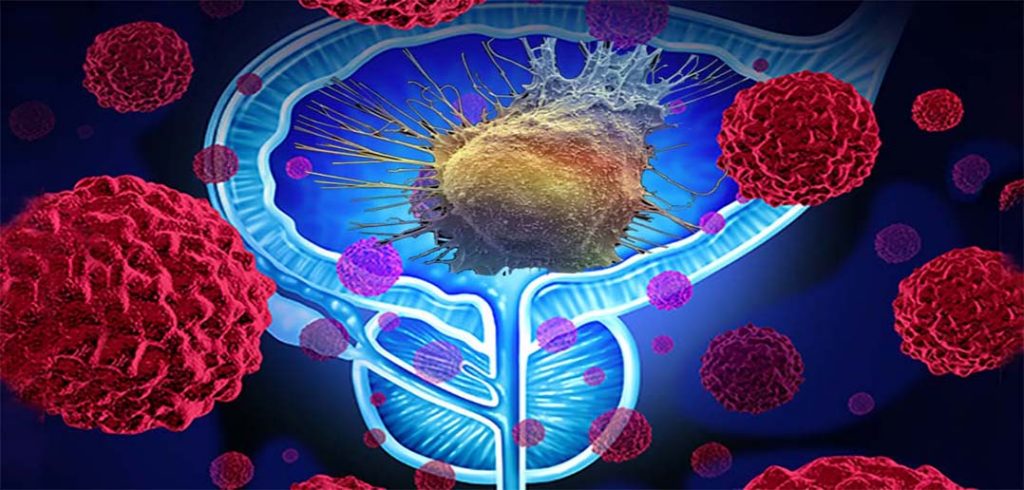 MRI assisted biopsies more effective at detecting prostate cancers