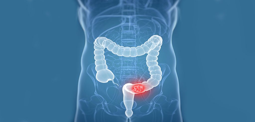Researchers identify roles of key genes in colon cancer development