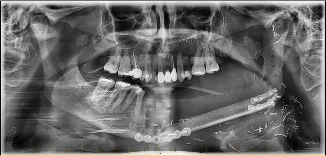 Twenty-hour ‘face-off’ surgery saves cancer patient’s life