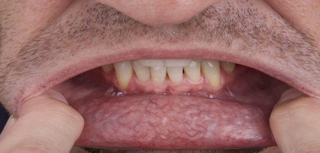 Researchers find new treatment for HPV-associated oral cancer