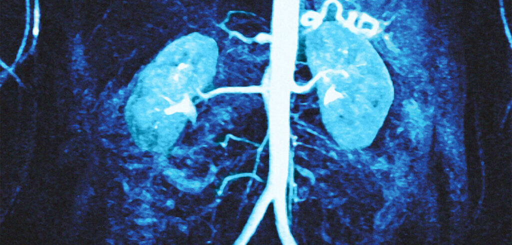 Massive study identifies new biomarkers for renal cancer subtypes