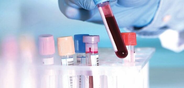 Capturing cancer cells from blood could guide breast cancer treatment ...